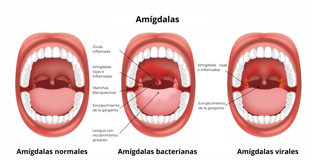 Amigdalitis: Causas, síntomas y tratamientos efectivos | Discapnet