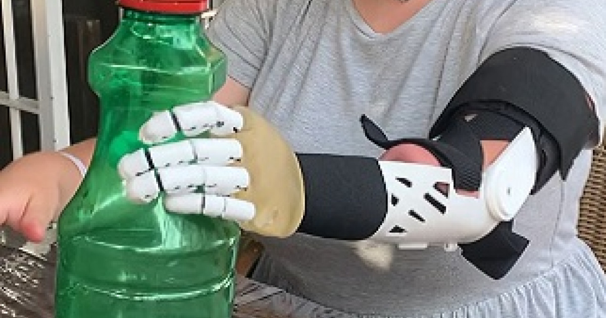 Crean una prótesis de antebrazo y mano con impresión 3D